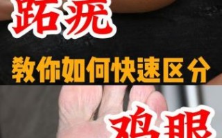 鸡眼初期症状图片_鸡眼和跖疣区别图解