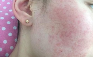 海鲜过敏脸部症状有哪些_海鲜过敏脸肿了怎么办