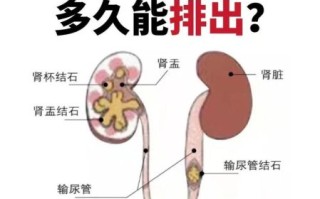 肾结石怎么排出_肾结石自然排出方法