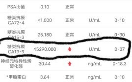 铁蛋白高是癌症吗_铁蛋白偏高怎么办