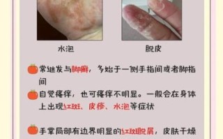 鹅掌风症状偏方大全_鹅掌风用什么偏方好得快