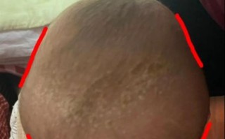 婴儿佝偻病睡姿图片_佝偻病宝宝正确睡姿