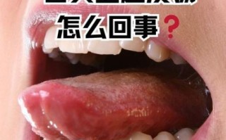 舌头溃疡一夜见效偏方_怎么快速止痛