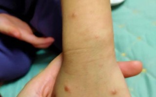 轻微手足口病症状图片_如何辨别早期皮疹