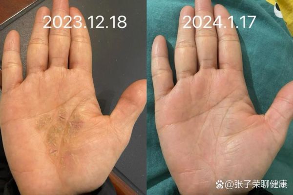 鹅掌风用醋泡多久能好_醋泡鹅掌风正确方法-第3张图片-山城妙识 鹅掌风用醋泡多久能好_醋泡鹅掌风正确方法-第3张图片-山城妙识