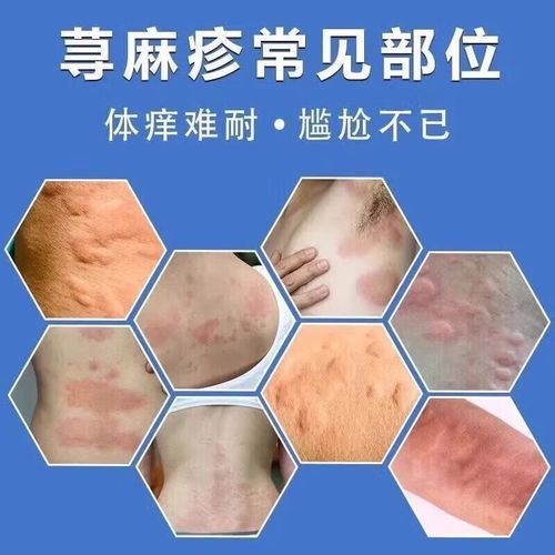 过敏吃什么药最有效果_过敏药多久见效-第3张图片-山城妙识 过敏吃什么药最有效果_过敏药多久见效-第3张图片-山城妙识