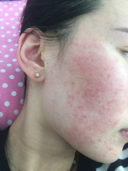 海鲜过敏脸部症状有哪些_海鲜过敏脸肿了怎么办-第1张图片-山城妙识