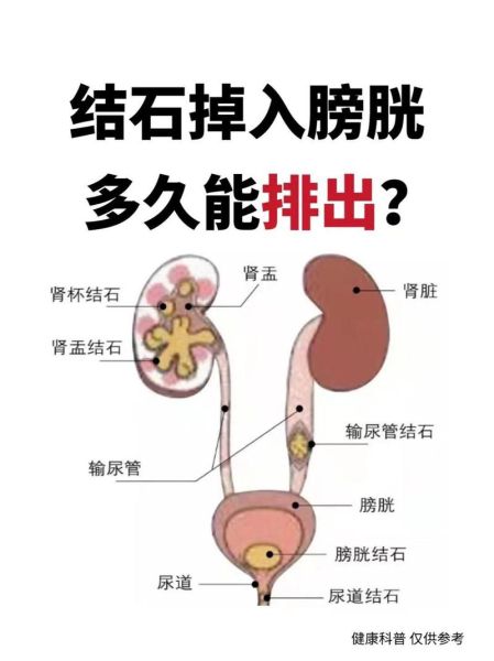 肾结石怎么排出_肾结石自然排出方法-第1张图片-山城妙识 肾结石怎么排出_肾结石自然排出方法-第1张图片-山城妙识