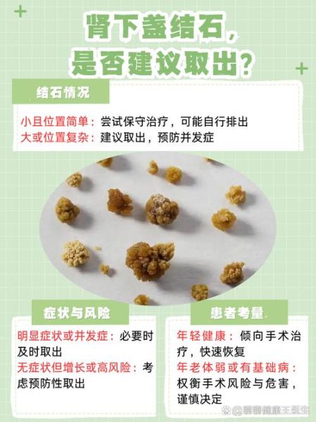 肾结石怎么排出_肾结石自然排出方法-第3张图片-山城妙识 肾结石怎么排出_肾结石自然排出方法-第3张图片-山城妙识