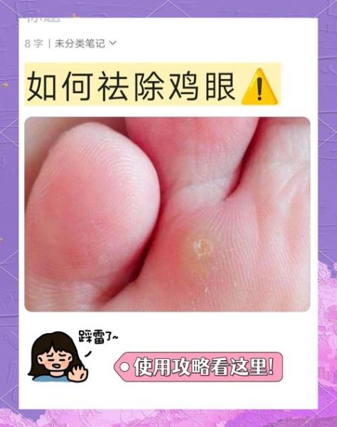 鸡眼怎么去除最好方法_鸡眼贴有用吗-第2张图片-山城妙识 鸡眼怎么去除最好方法_鸡眼贴有用吗-第2张图片-山城妙识