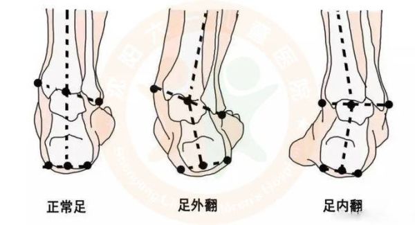 马蹄脚是什么_马蹄脚图片怎么判断-第3张图片-山城妙识 马蹄脚是什么_马蹄脚图片怎么判断-第3张图片-山城妙识