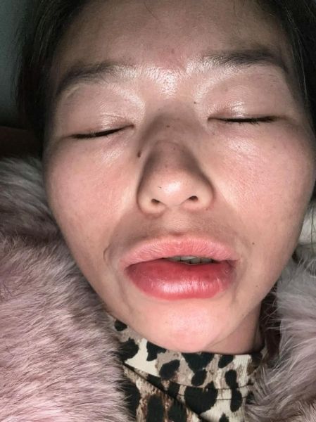 香肠嘴是怎么引起的_嘴唇突然肿厚怎么办-第3张图片-山城妙识