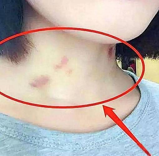 草莓印怎么快速消除_草莓印多久能消-第1张图片-山城妙识