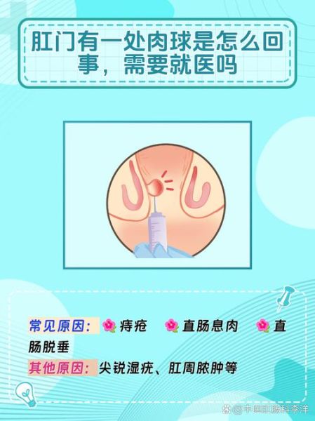 肛门肉球能自己消除吗_肛门肉球多久会好-第2张图片-山城妙识 肛门肉球能自己消除吗_肛门肉球多久会好-第2张图片-山城妙识