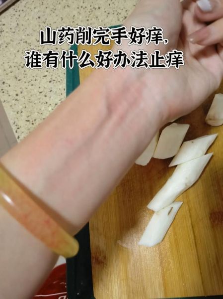 山药痒手怎么办_最有效方法-第1张图片-山城妙识