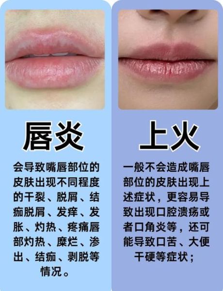 嘴唇上火起泡怎么快速消除_小妙招-第3张图片-山城妙识 嘴唇上火起泡怎么快速消除_小妙招-第3张图片-山城妙识