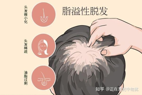 脱发怎么治疗效果好_脱发怎么恢复发量-第2张图片-山城妙识 脱发怎么治疗效果好_脱发怎么恢复发量-第2张图片-山城妙识