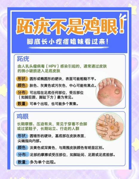 鸡眼初期症状图片_鸡眼和跖疣区别图解-第2张图片-山城妙识 鸡眼初期症状图片_鸡眼和跖疣区别图解-第2张图片-山城妙识