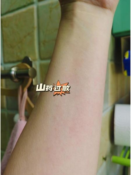 山药过敏了怎么能快速止痒_山药过敏止痒小妙招-第3张图片-山城妙识 山药过敏了怎么能快速止痒_山药过敏止痒小妙招-第3张图片-山城妙识