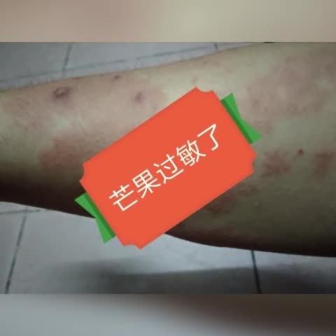 吃芒果过敏的症状图片_芒果过敏多久会出现反应-第2张图片-山城妙识 吃芒果过敏的症状图片_芒果过敏多久会出现反应-第2张图片-山城妙识