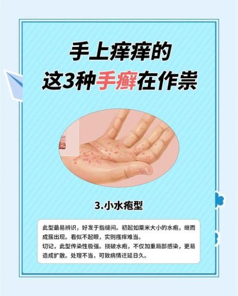 手痒怎么快速止痒_手痒止痒最简单的方法-第2张图片-山城妙识 手痒怎么快速止痒_手痒止痒最简单的方法-第2张图片-山城妙识