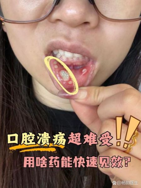 口腔溃疡怎么办最快愈合_小偏方真的有用吗-第3张图片-山城妙识 口腔溃疡怎么办最快愈合_小偏方真的有用吗-第3张图片-山城妙识