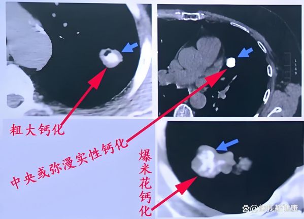爆米花肺是怎么形成的_爆米花肺病因详解-第3张图片-山城妙识 爆米花肺是怎么形成的_爆米花肺病因详解-第3张图片-山城妙识
